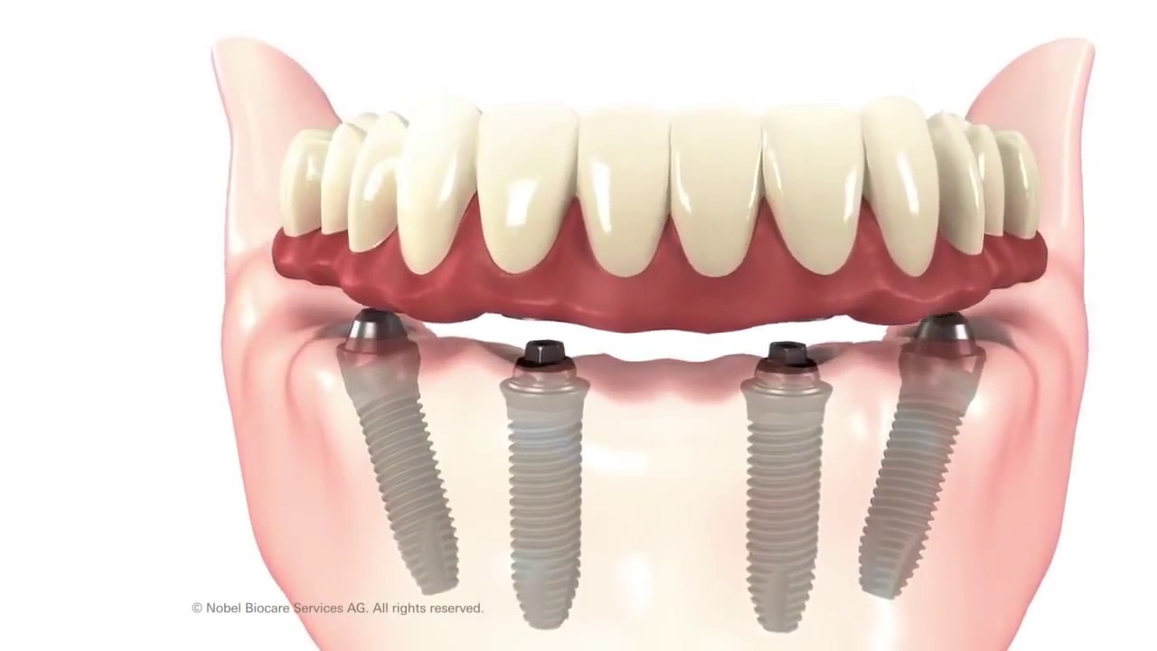 Dental Implants - Truro Dentists | Bible Hill Family Dentistry